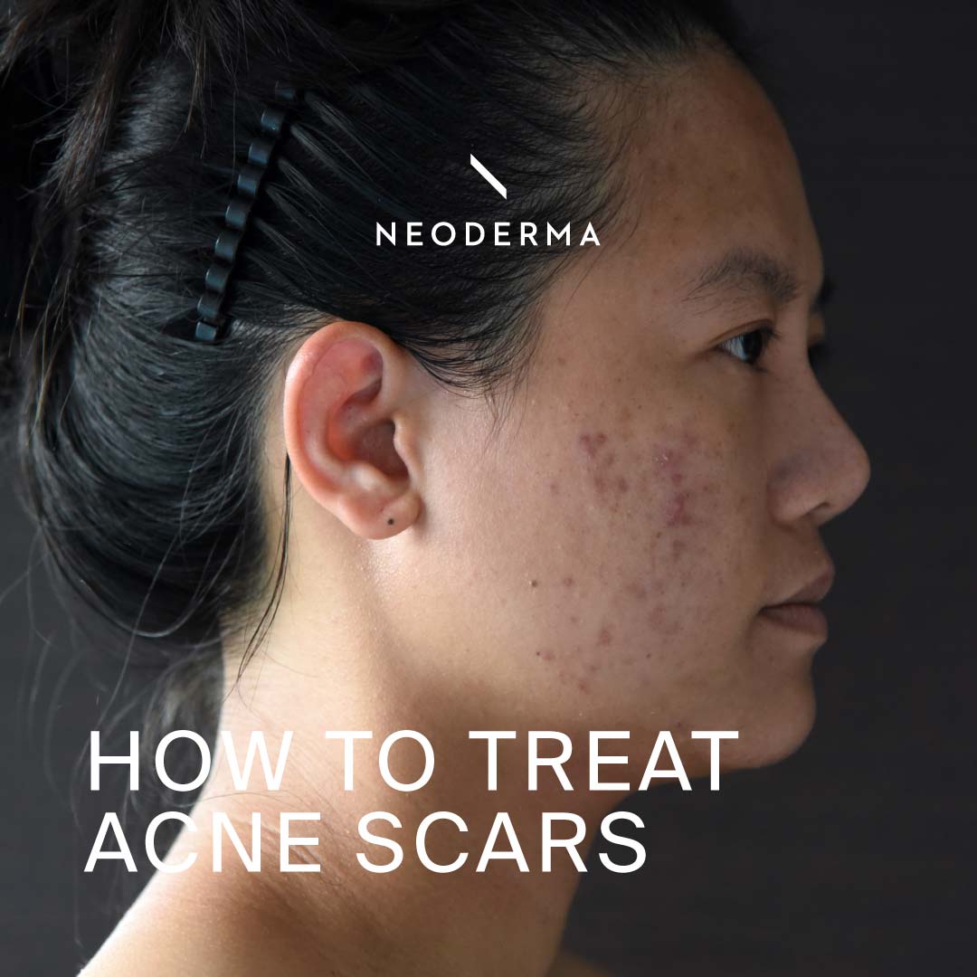 How to treat Acne Scars – NEODERMA