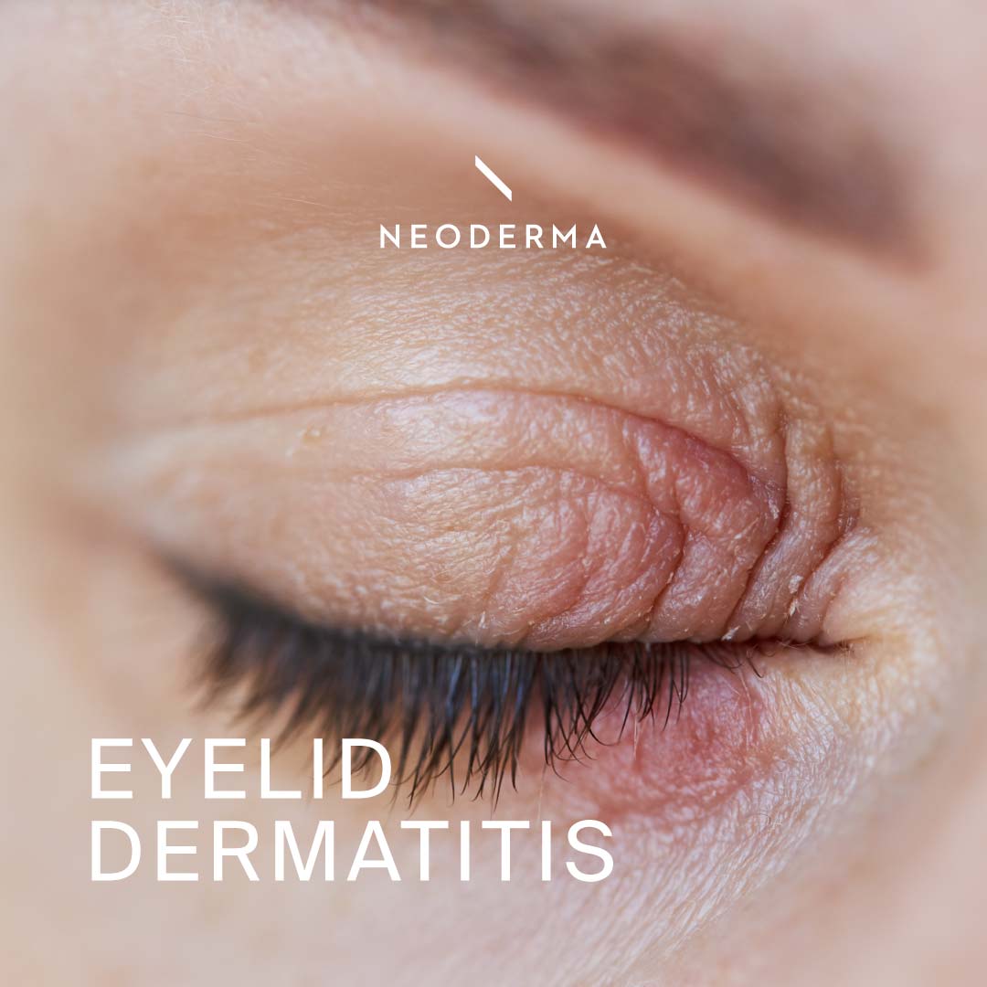 Eyelid Dermatitis – NEODERMA